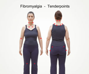 Fibromyalgia (FMS - FibroMyalgia Syndrome) Treatment Stockbridge ...